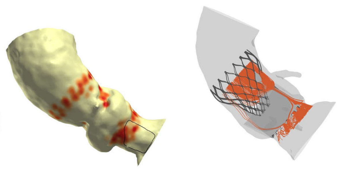 PRECISE-TAVI - FEops